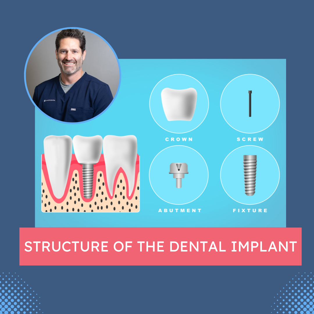 How Successful is Dental Implant Treatment? | Geach Dental
